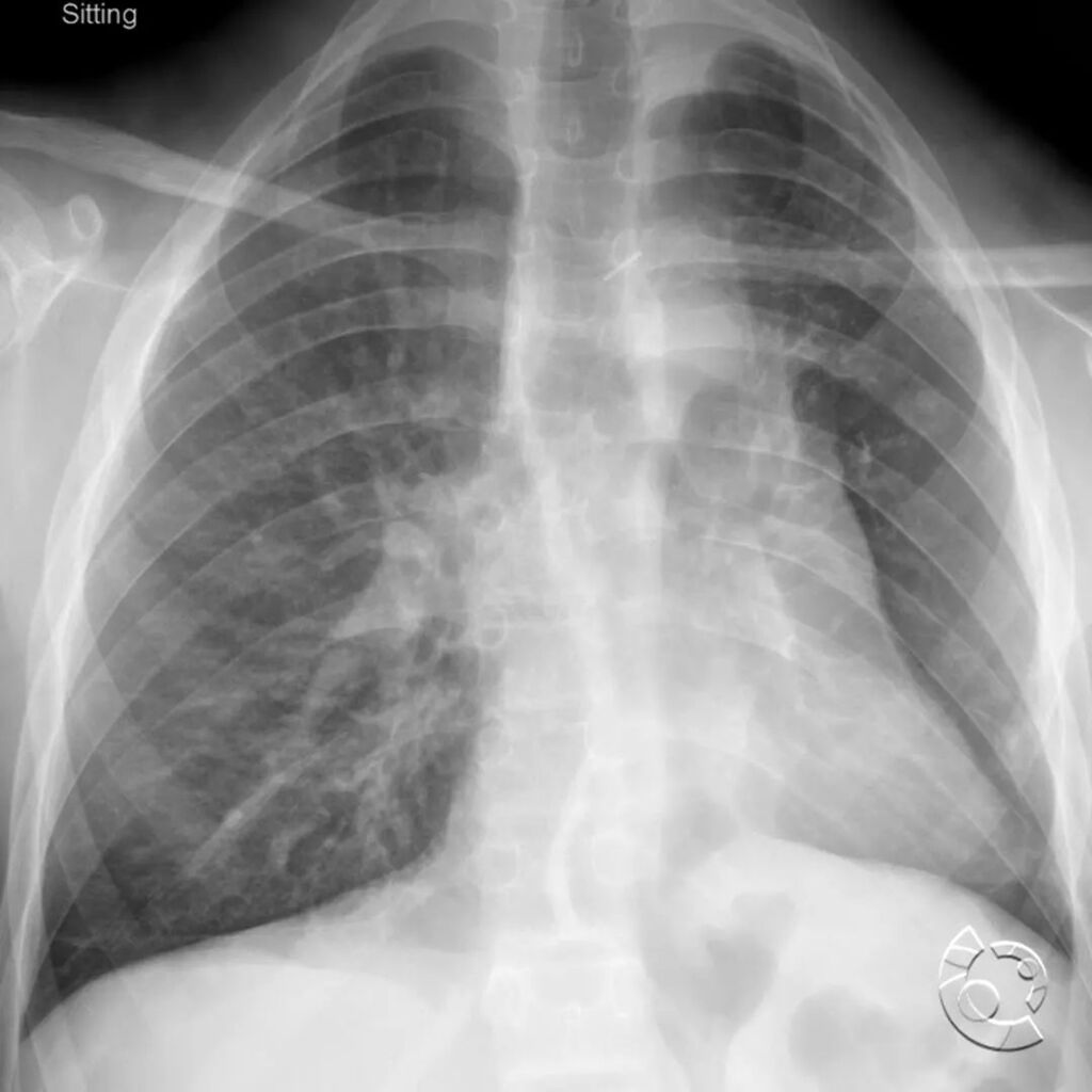 Xray 1 18 2 The Reliability Of The Neer Classification For Proximal
