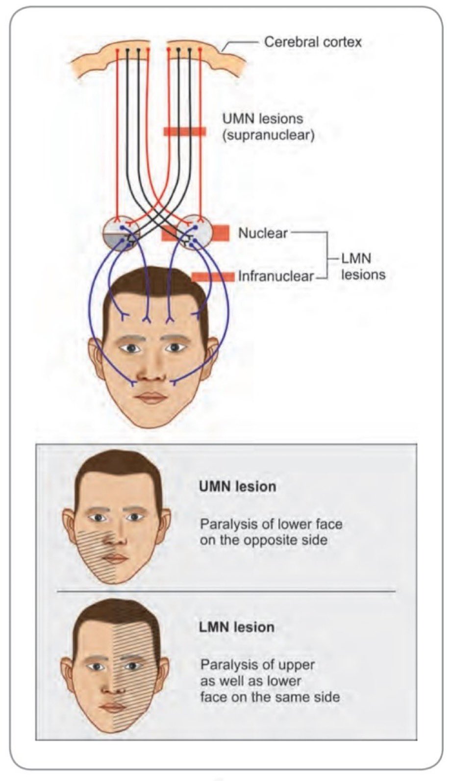 Lesions Of Upper Motor Neurons And Lower Motor Neurons