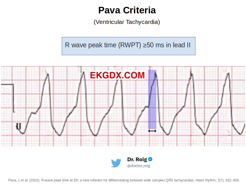 1/ Today's 🧵is about "VT" versus "SVT with aberrancy". The aim of this ...