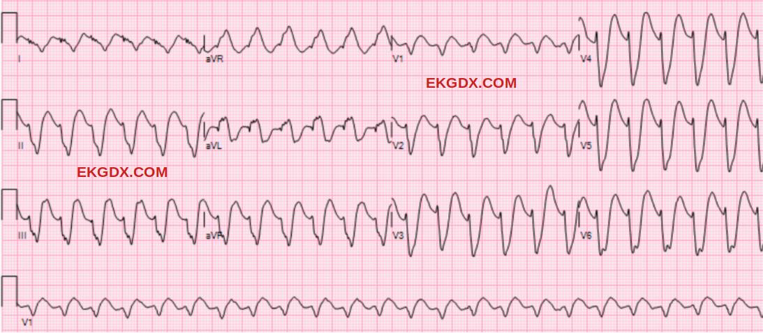 1/ Today's 🧵is about "VT" versus "SVT with aberrancy". The aim of this ...