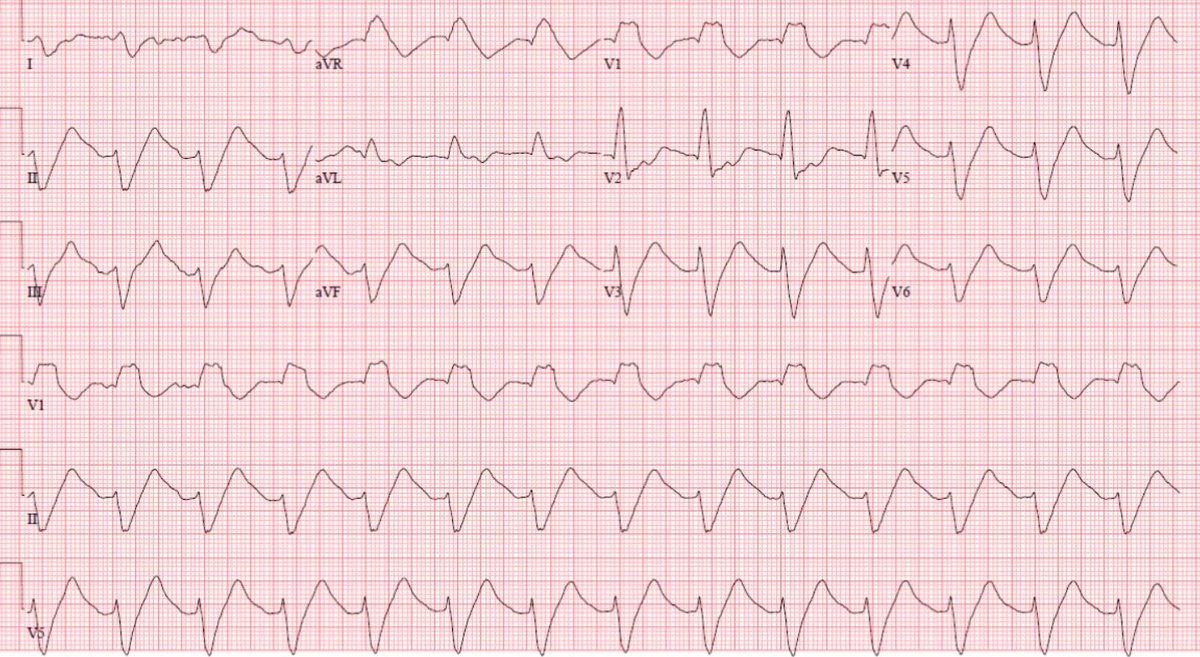 1/ Today's 🧵is about "VT" versus "SVT with aberrancy". The aim of this ...