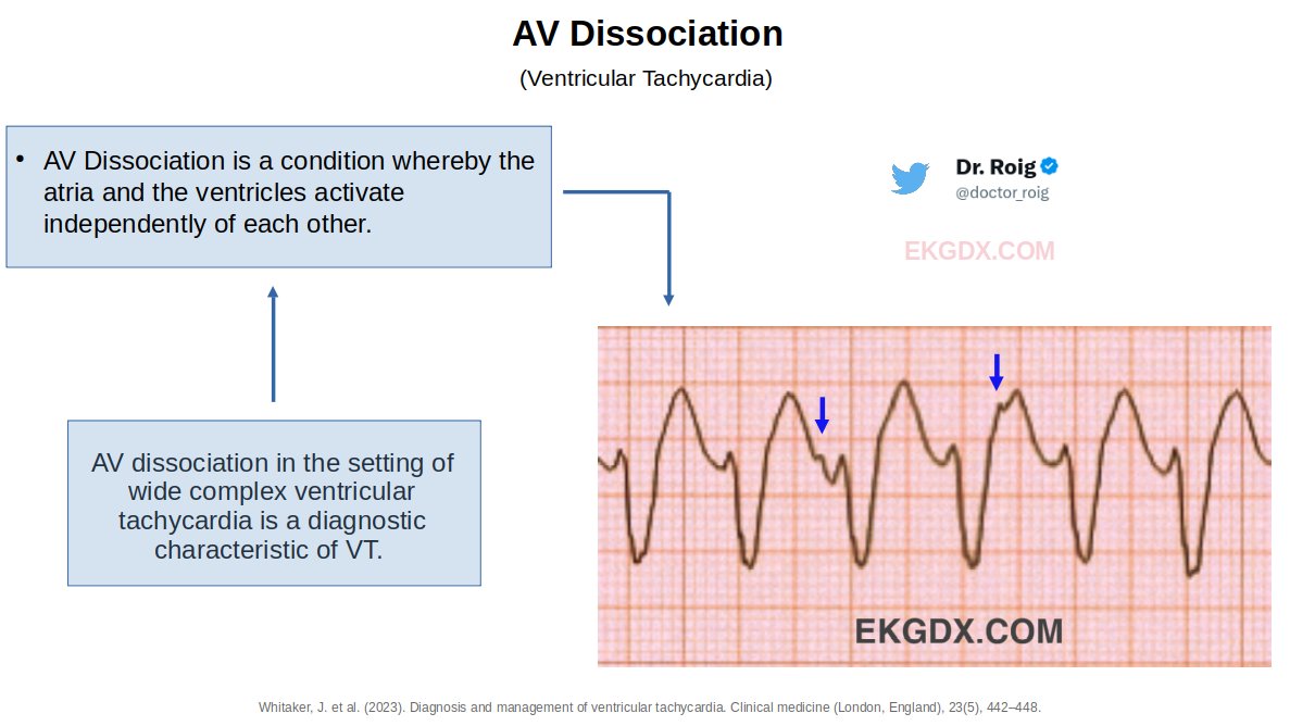 1/ Today's 🧵is about "VT" versus "SVT with aberrancy". The aim of this ...