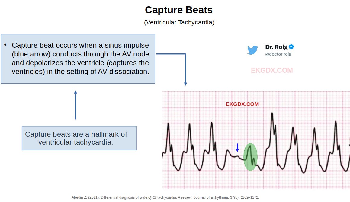1/ Today's 🧵is about "VT" versus "SVT with aberrancy". The aim of this ...