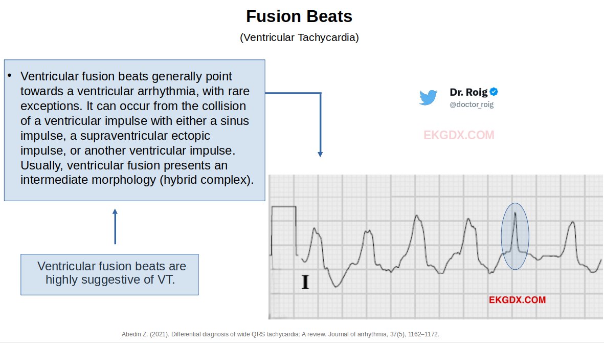 1/ Today's 🧵is about "VT" versus "SVT with aberrancy". The aim of this ...