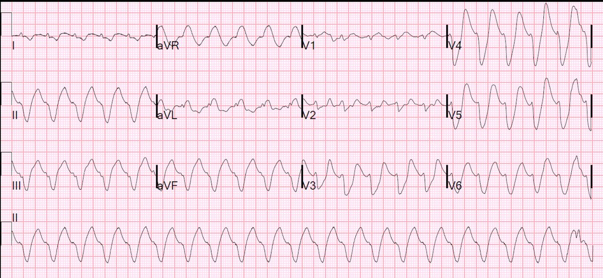 1/ Today's 🧵is about "VT" versus "SVT with aberrancy". The aim of this ...