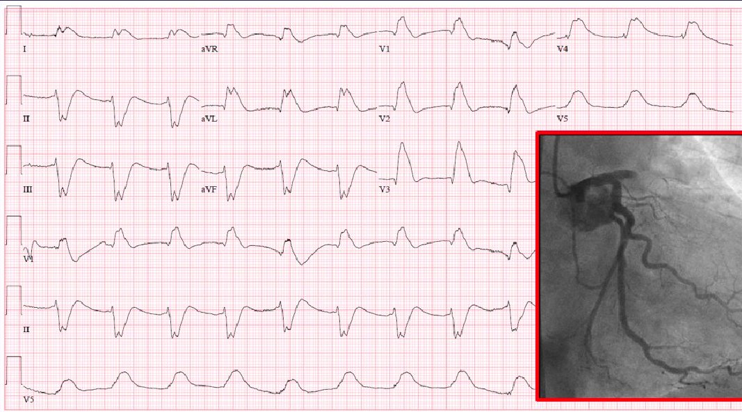 1/ Today's 🧵is about "VT" versus "SVT with aberrancy". The aim of this ...