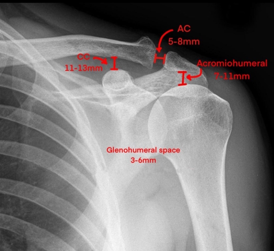 Hombro Normal De Rayos X