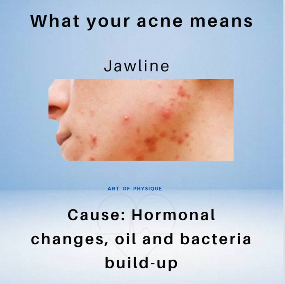 Acne Face Mapping: How To Determine the Cause of Your Breakouts..... 1 ...