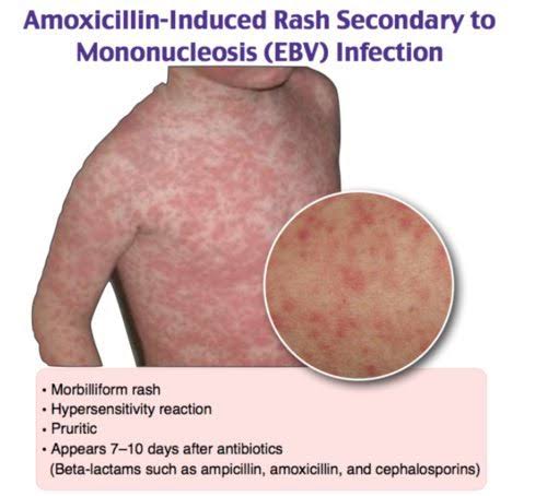 Amoxicillin Rash