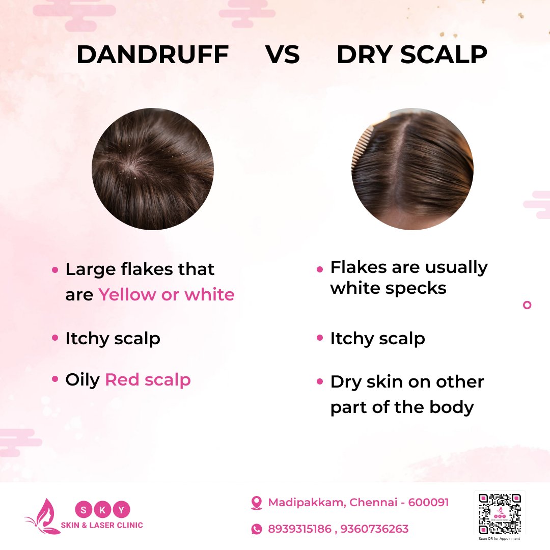 Dandruff Flakes Vs Dry Scalp Flakes Dandruff Vs. Dry Scalp: Know The