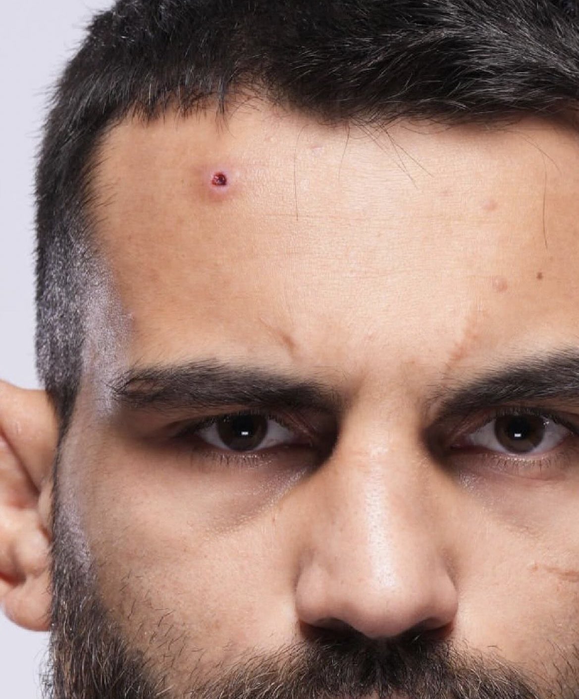 Staph Infection On Forehead