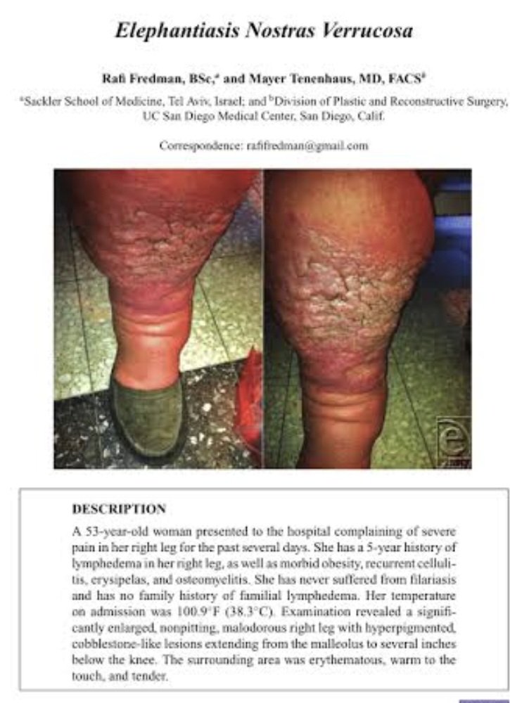 Elephantiasis Scrotum The New Humanitarian | Elephantiasis Thrives