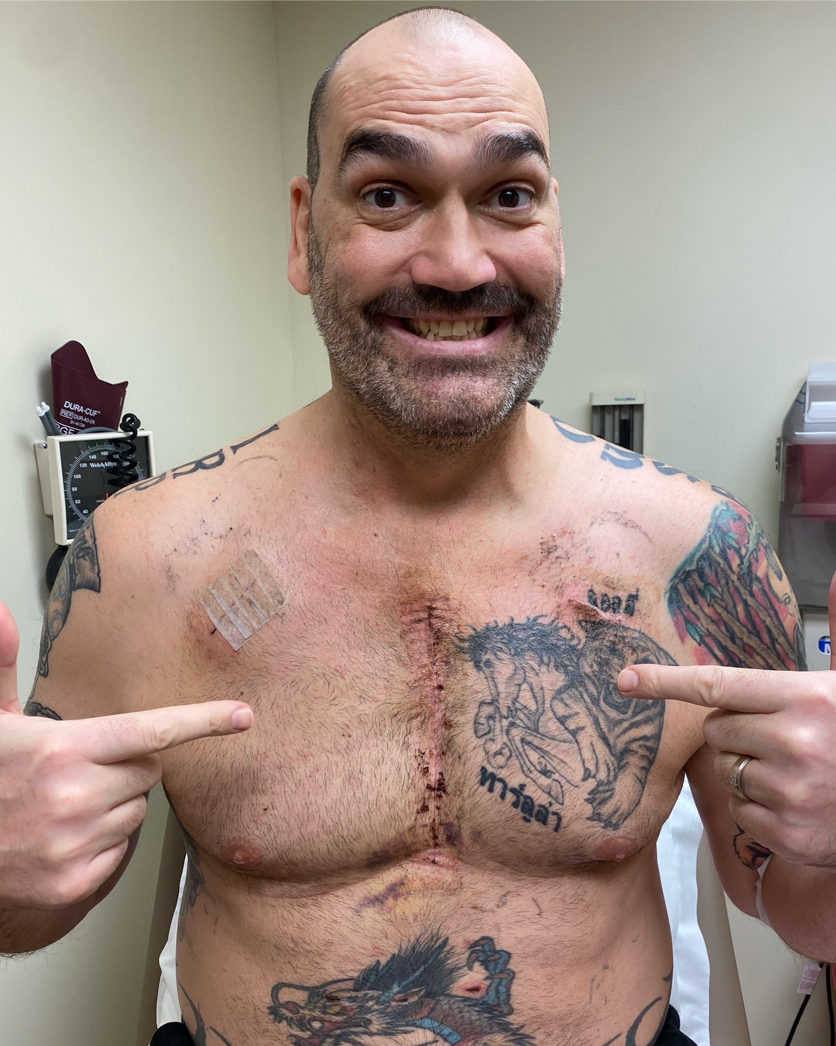 Pacemaker scar tattoo - Bronctattooaus.com