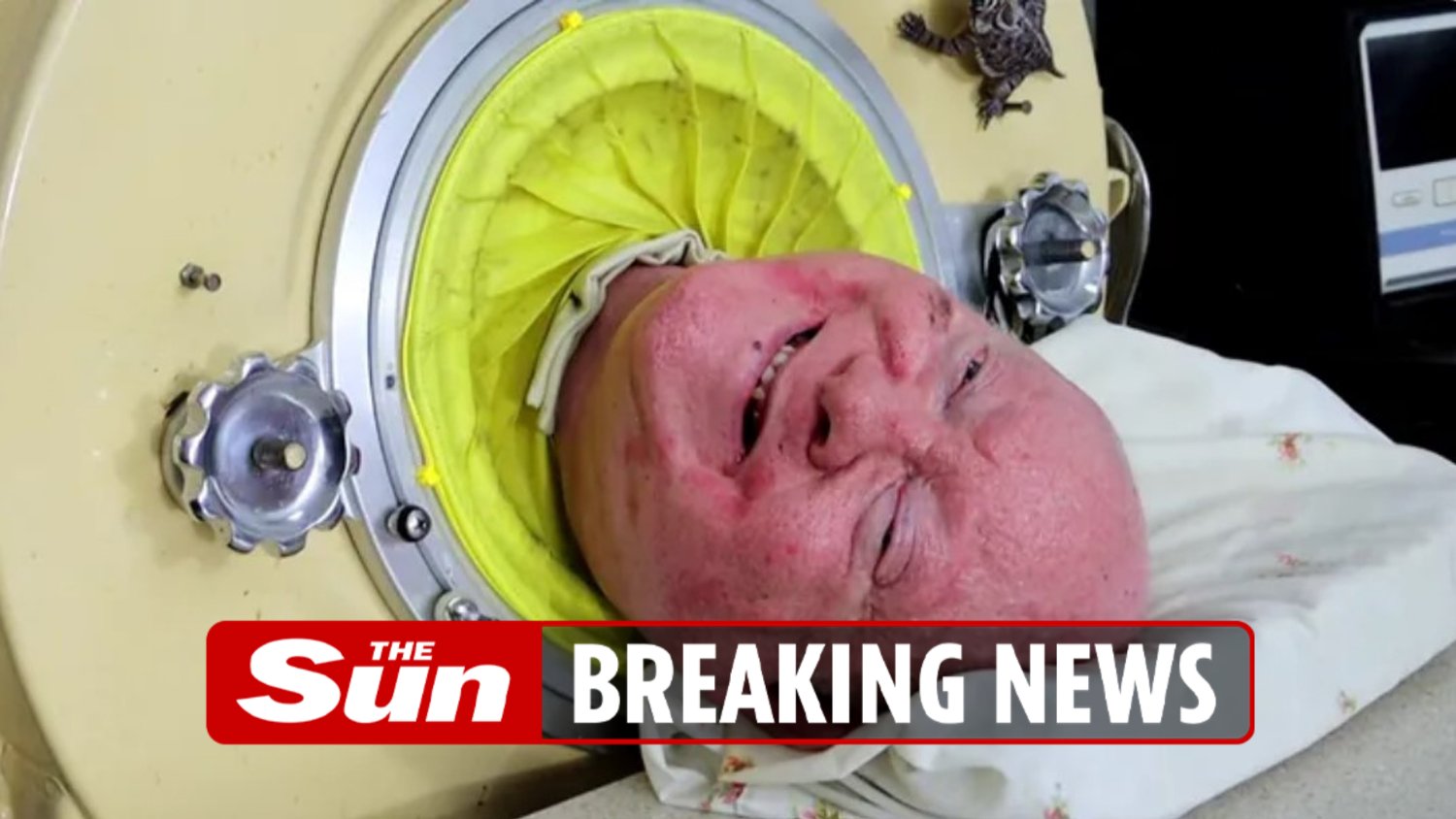 Polio Iron Lung Iron Lung: 1929 Drinker Respirator