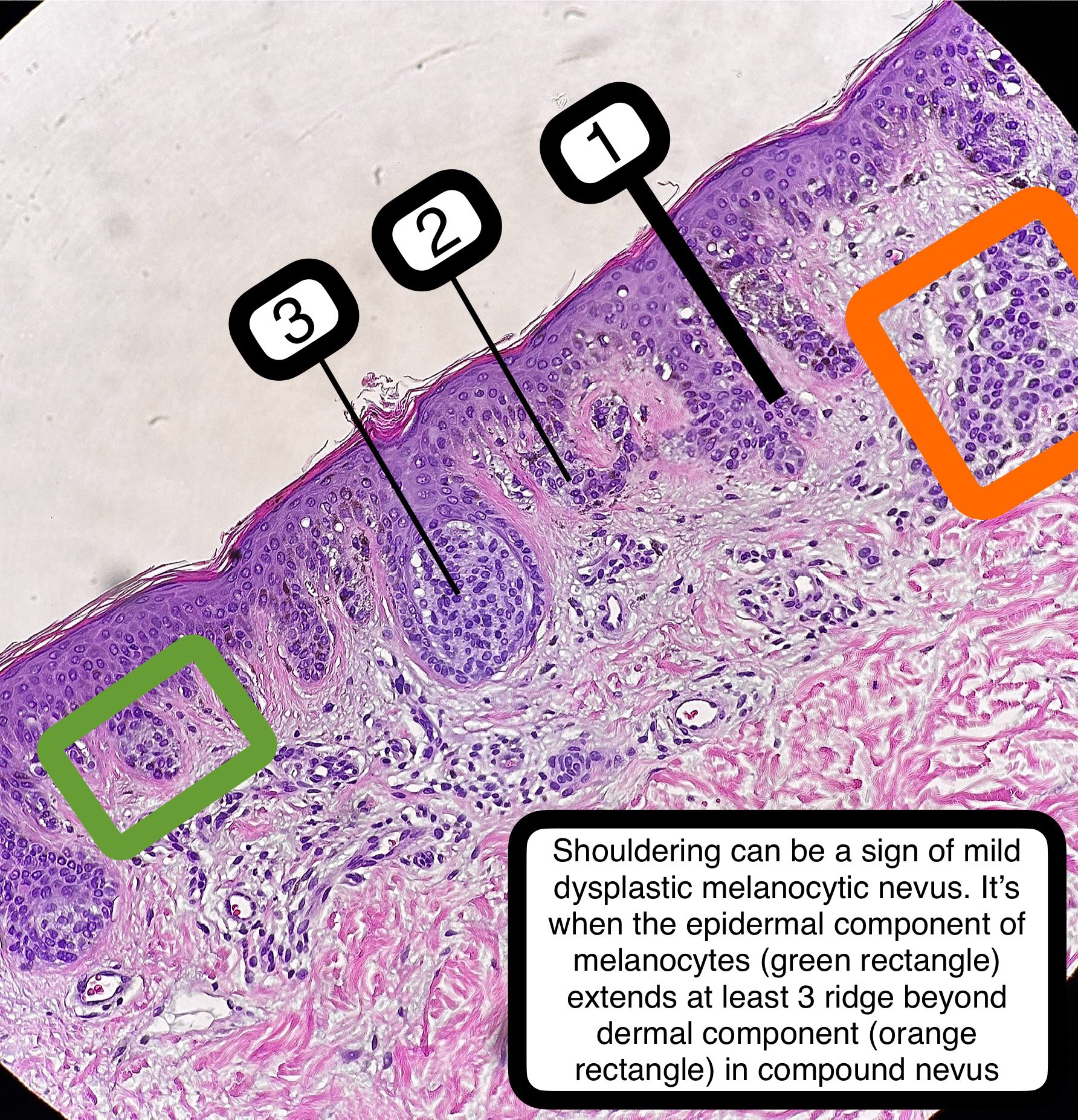 Dysplastic Nevus Histology