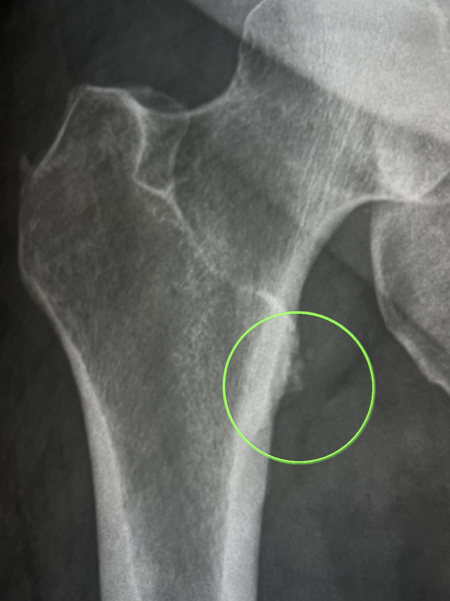 Lesser Trochanter Avulsion