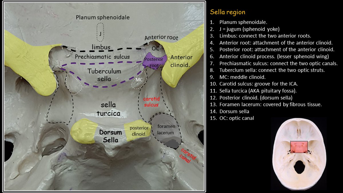 Posterior Clinoid Process The Pneumatisation Of Anterior Clinoid