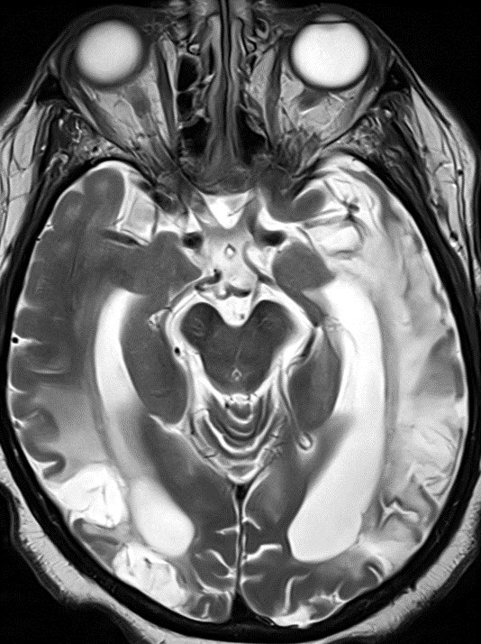 Neuroimaging checklist for the patient with Temporal Lobe Epilepsy (TLE ...
