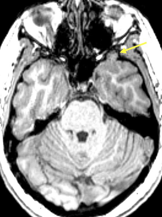 Neuroimaging checklist for the patient with Temporal Lobe Epilepsy (TLE ...