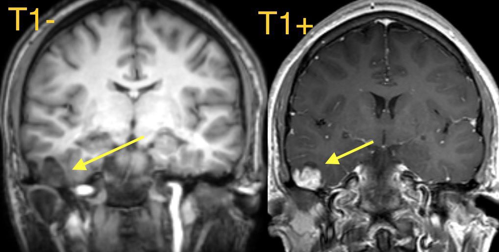 Neuroimaging checklist for the patient with Temporal Lobe Epilepsy (TLE ...