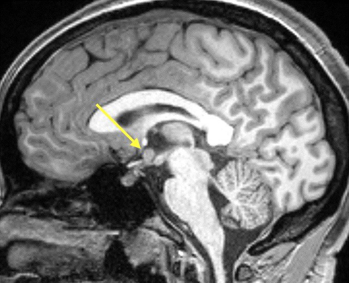 Neuroimaging checklist for the patient with Temporal Lobe Epilepsy (TLE ...