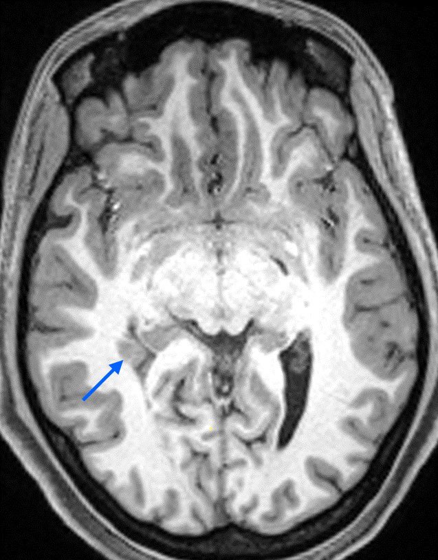 Neuroimaging checklist for the patient with Temporal Lobe Epilepsy (TLE ...