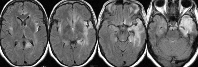 Neuroimaging checklist for the patient with Temporal Lobe Epilepsy (TLE ...
