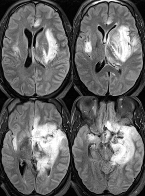 Neuroimaging checklist for the patient with Temporal Lobe Epilepsy (TLE ...