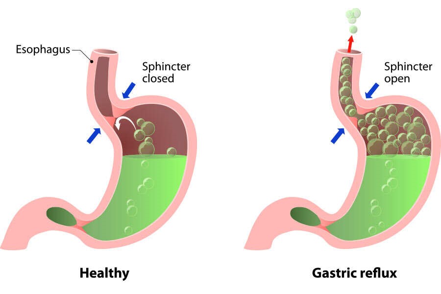 thiamine deficiency is the sneaky culprit of: - inability to digest ...