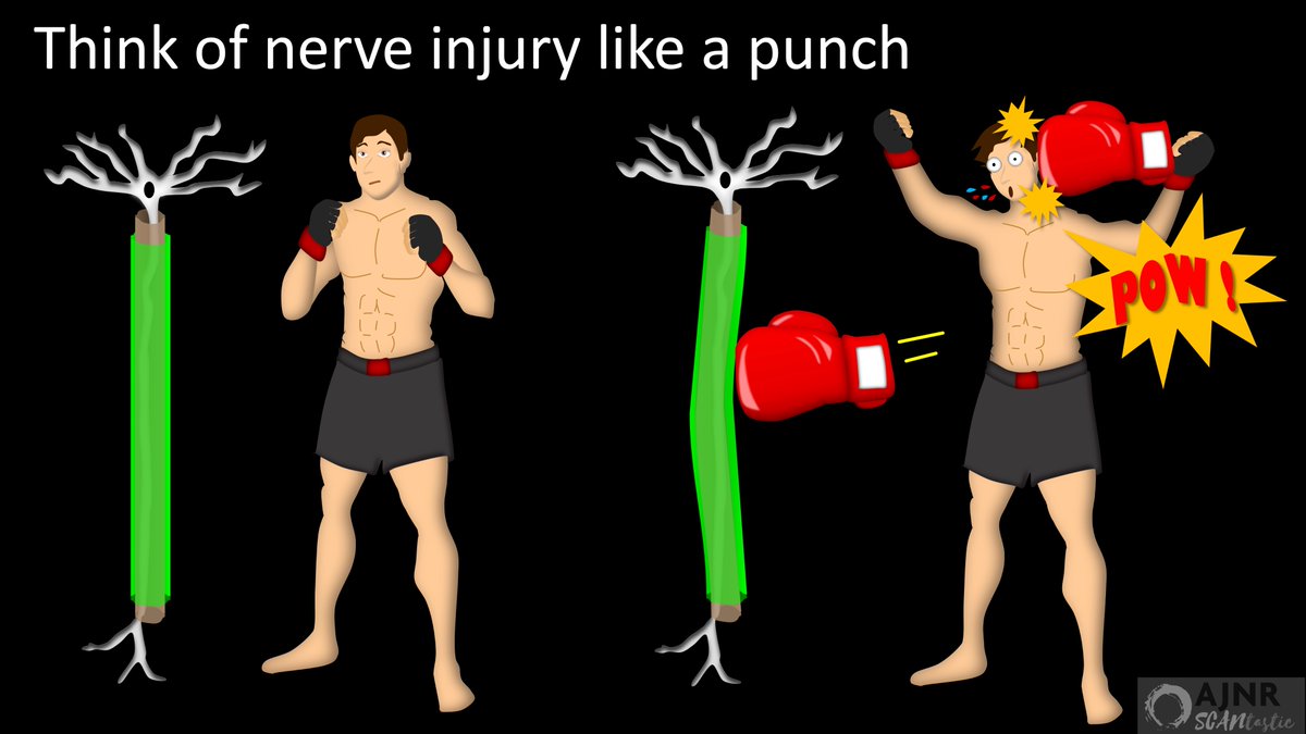 1/Does trying to diagnose trigeminal neuralgia give you a splitting ...