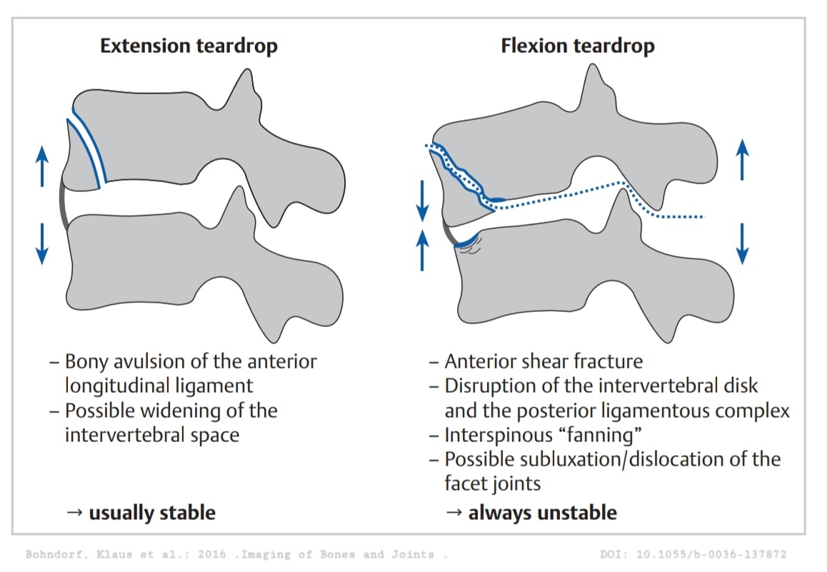 Flexion Teardrop Fracture Teardrop Fractures | The Bone School