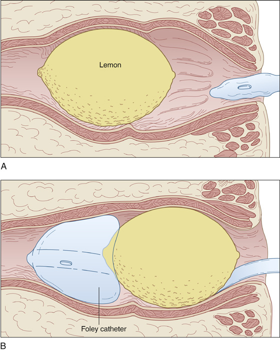 🧵regarding some of the more novel *non-urologic* uses of Foley ...