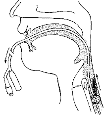🧵regarding some of the more novel *non-urologic* uses of Foley ...