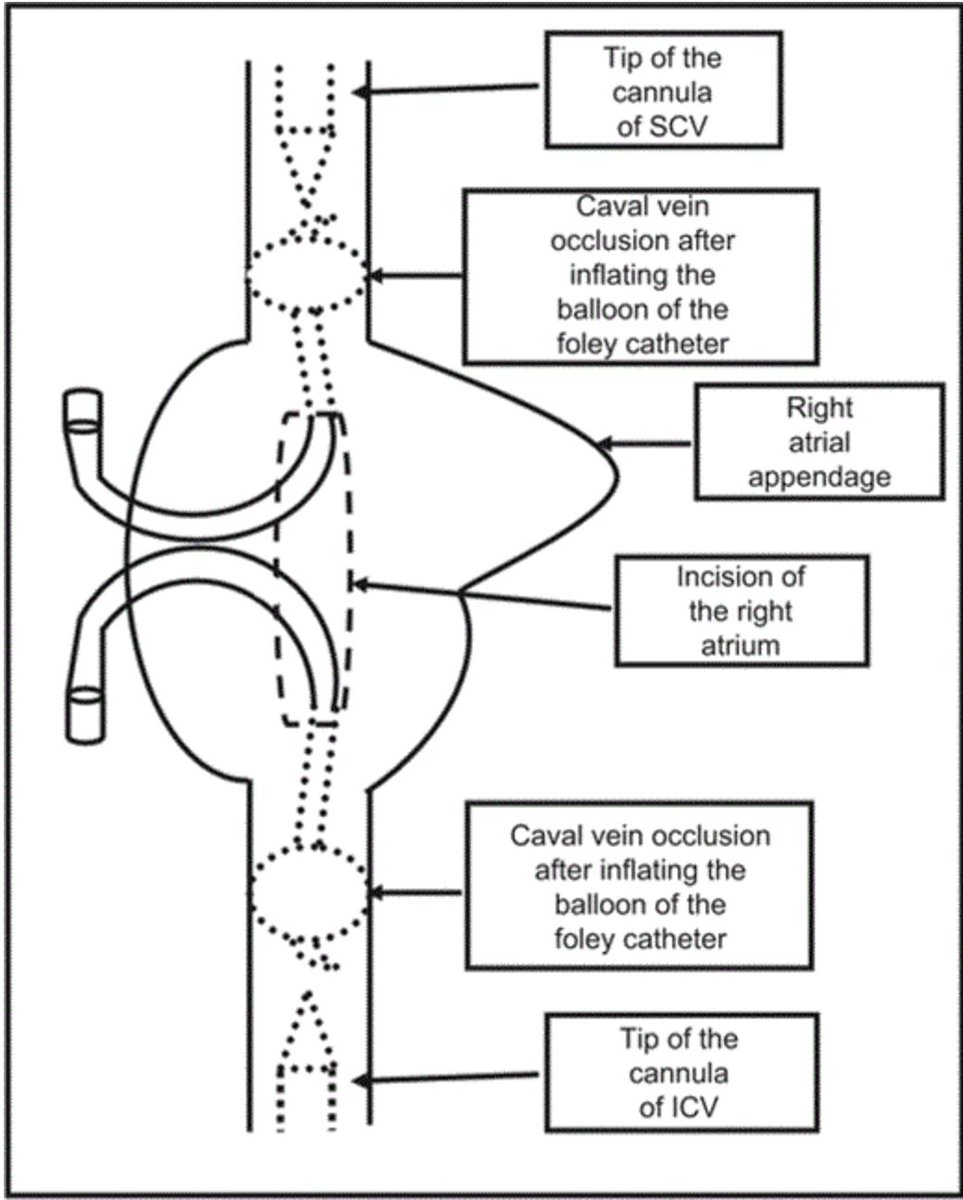 🧵regarding some of the more novel *non-urologic* uses of Foley ...