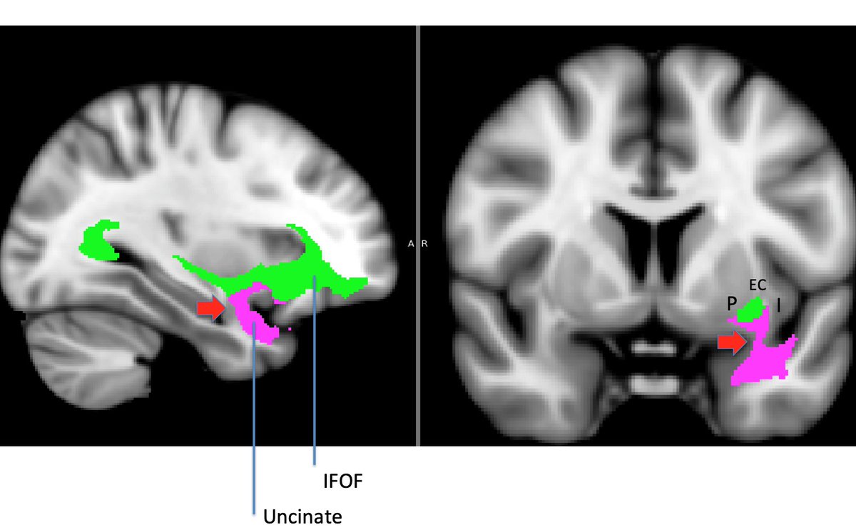 A white matter tract that takes 30 years to mature must be doing ...