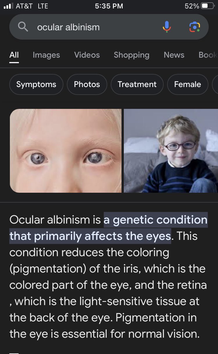Ocular Albinism Eyes Iris Transillumination In Child With