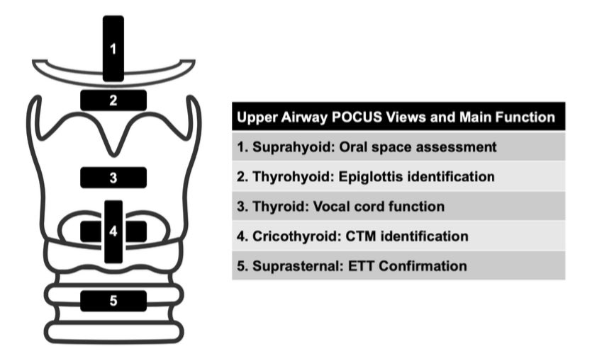 #POCUS #MedTwitter 1/ ️ Difficult Airway Evaluation with Sonography ...