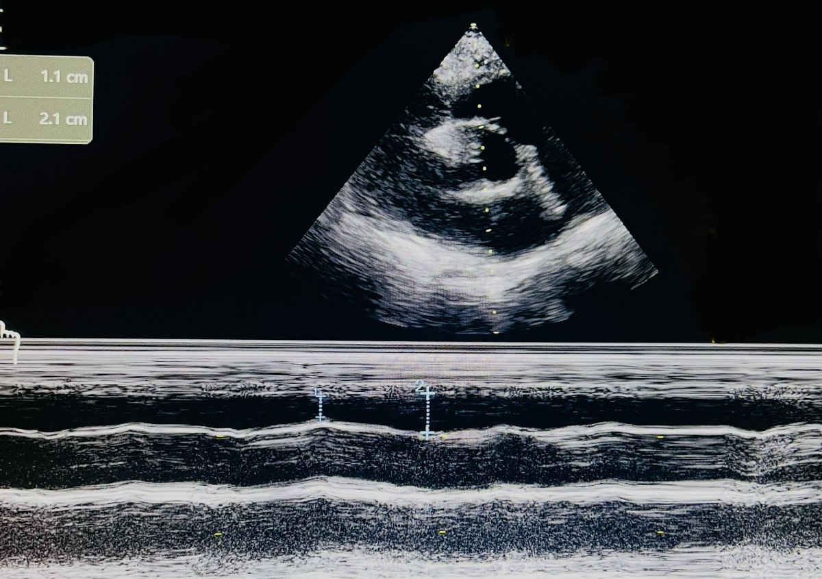 #POCUS #MedTwitter #FOAMed How can POCUS differentiate Acute PE and ...