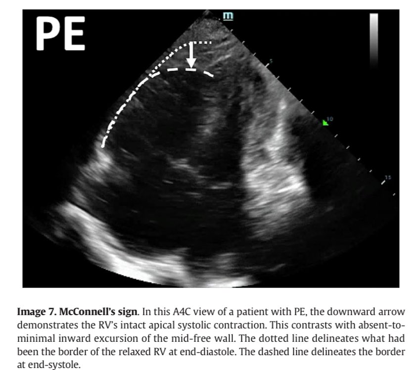 #POCUS #MedTwitter #FOAMed How can POCUS differentiate Acute PE and ...