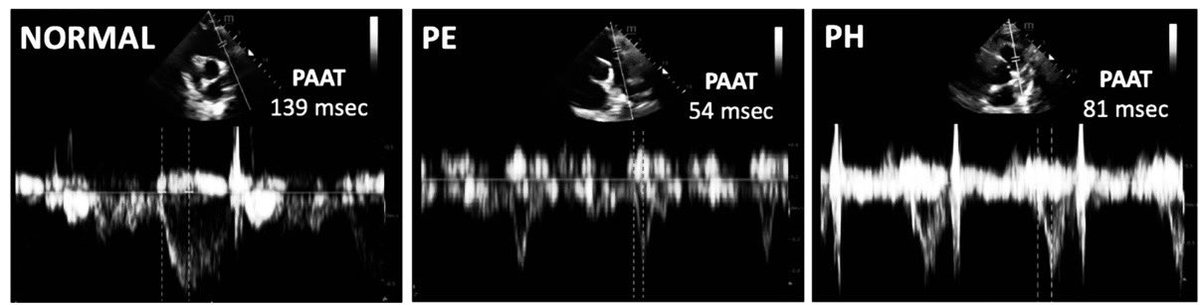 #POCUS #MedTwitter #FOAMed How can POCUS differentiate Acute PE and ...
