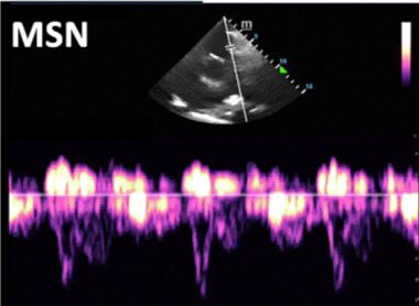 #POCUS #MedTwitter #FOAMed How can POCUS differentiate Acute PE and ...