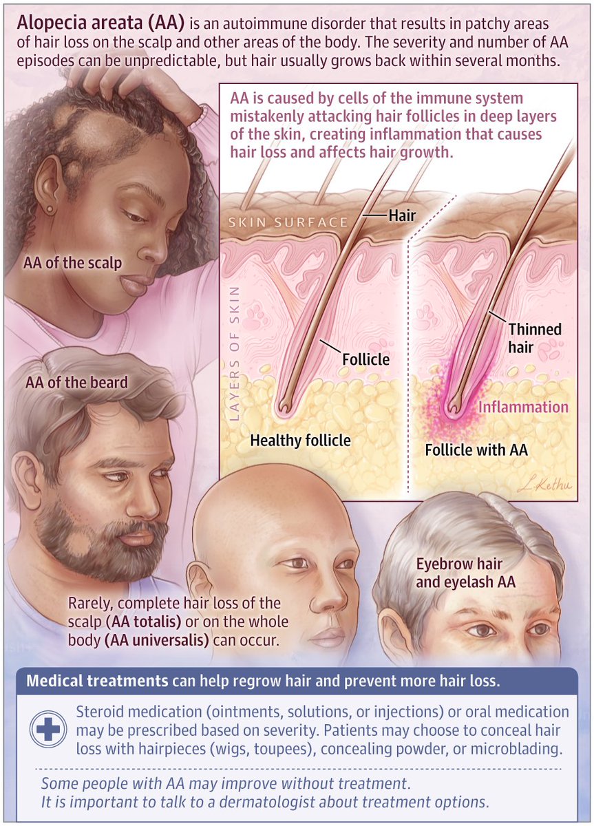 JAMA Dermatology on X Alopecia areata AA is a type of hair loss disorder caused by the immune system. This Patient Page describes the symptoms diagnosis and treatment of alopecia areata. https t mb...