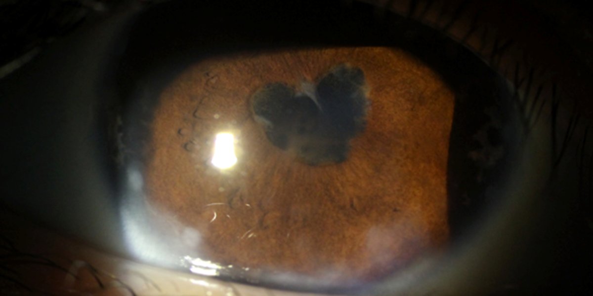 Anterior Synechiae Slit Lamp