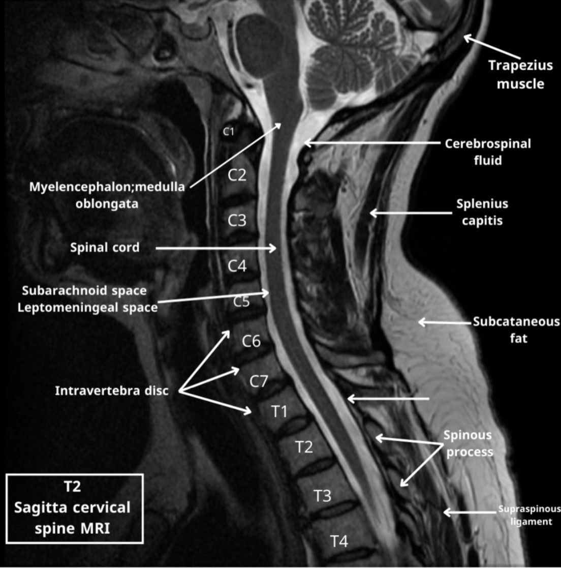Cervical Spine Mri Labeled