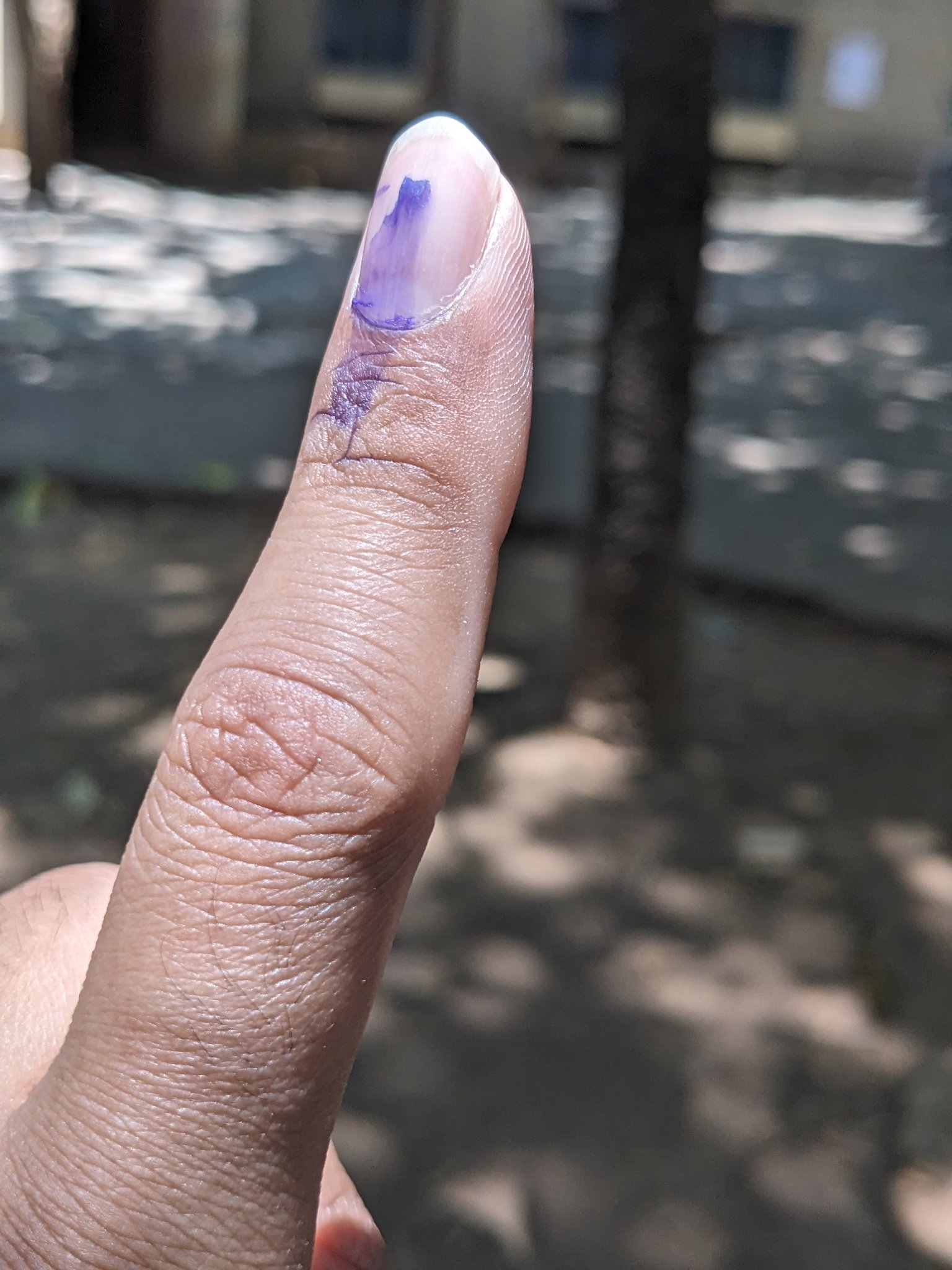 Smashed Finger Treatment