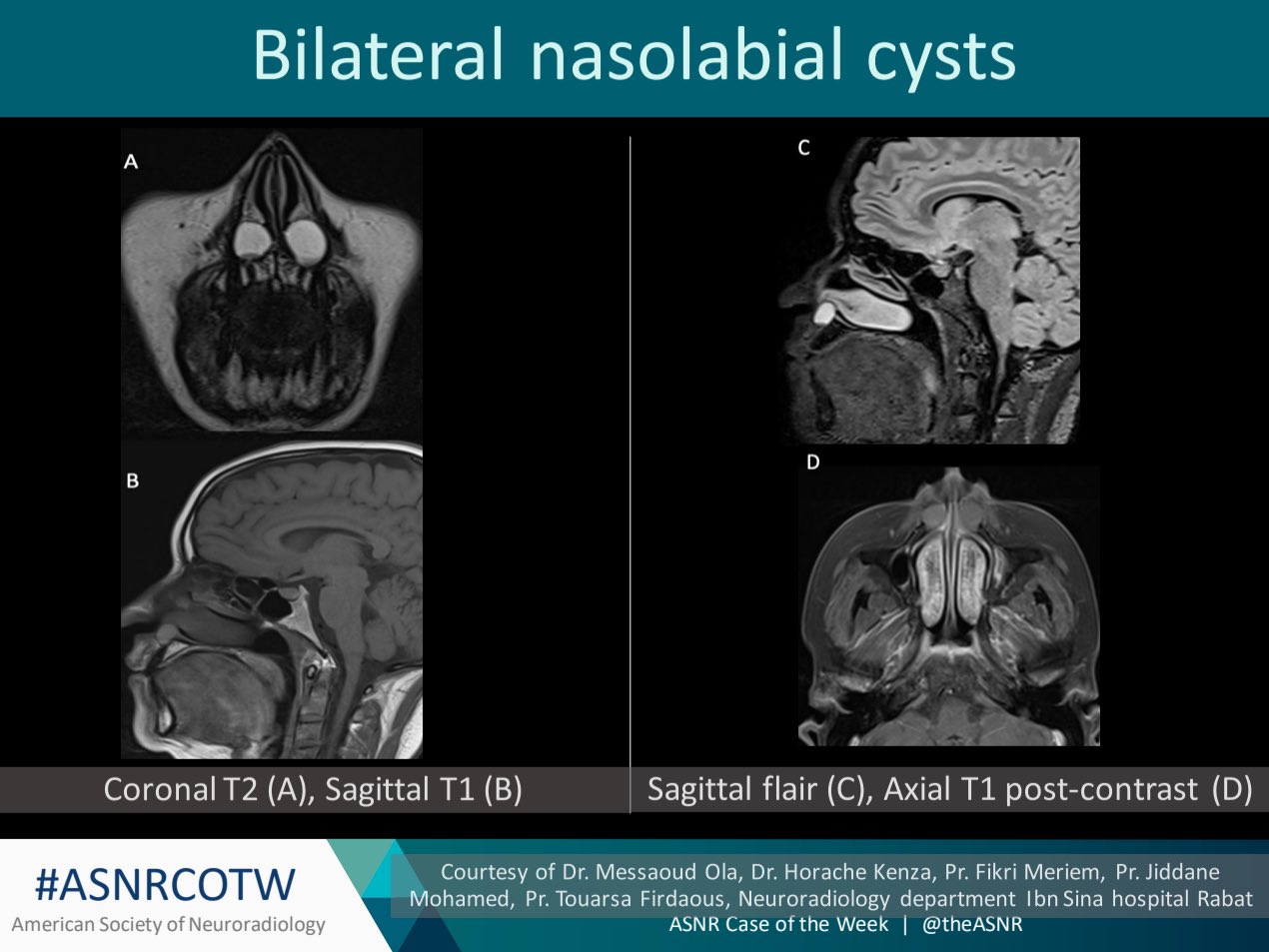 Nasolabial Cyst Spheric Mass Beneath The Alar Base: MR Images Of