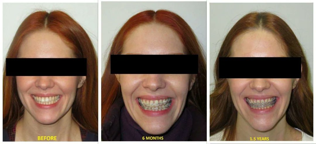 Here are 5 permanent harms of braces that everybody needs to be aware ...