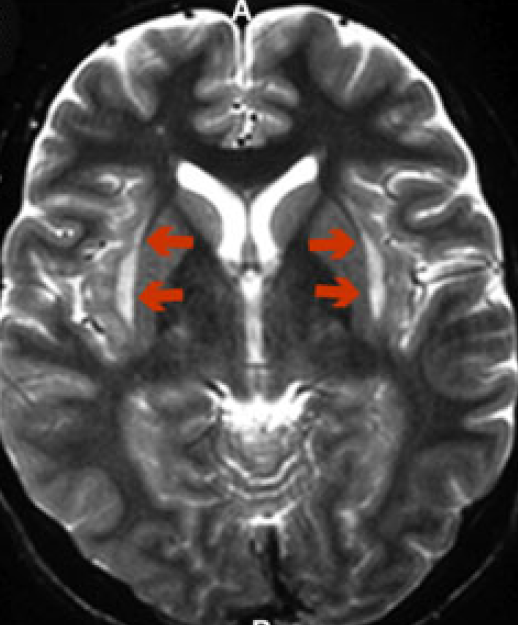 Does human consciousness rely on this tiny wisp of gray matter ...