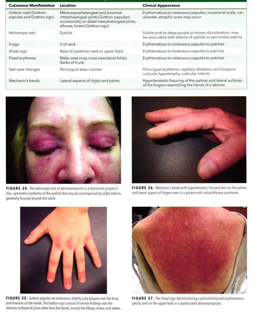 Gottrons Sign Adult Idiopathic Inflammatory Myopathies Medicine