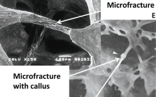 BONE'S ABILITY TO GO THROUGH PLASTIC DEFORMATION AND MICROFRACTURES FOR ...